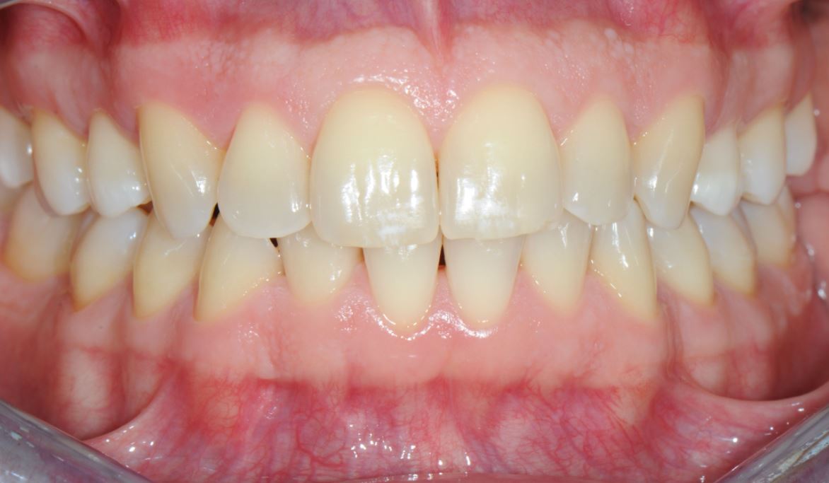 Gengivite: sintomi, cura • Gengive.org