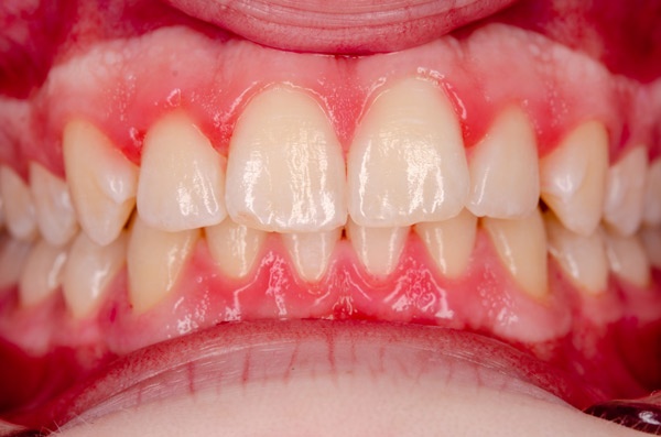 Gengivite Grave Prima E Dopo