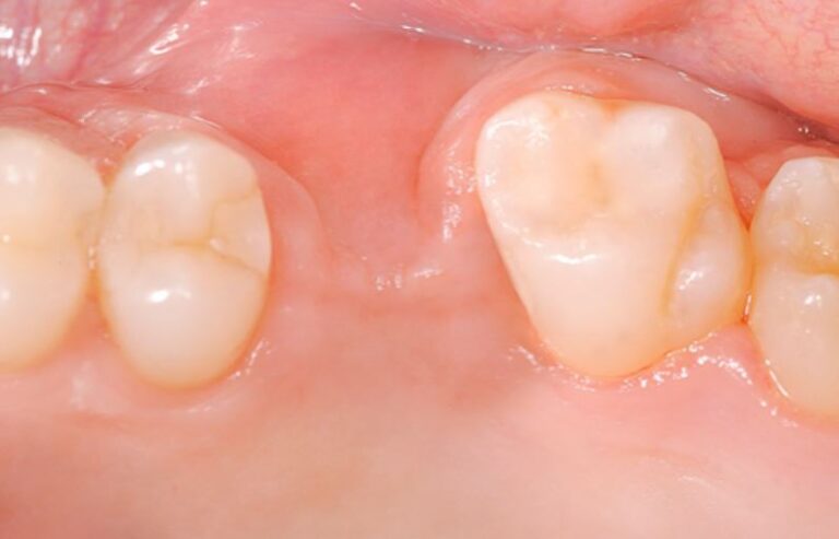 Edentulie: cosa sono? • Gengive.org