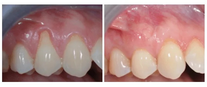 Le gengive ritirate ricrescono?ghtyh • Terapie • Gengive.org