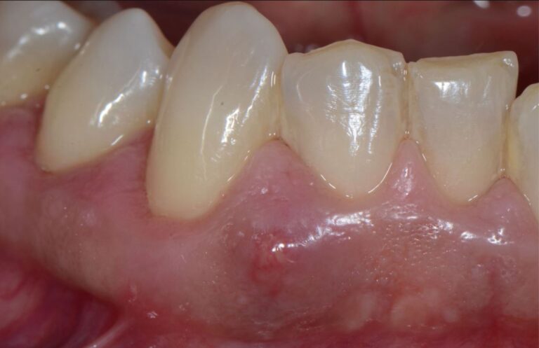 Gengiva gonfia: ho la parodontite? • Gengive.org