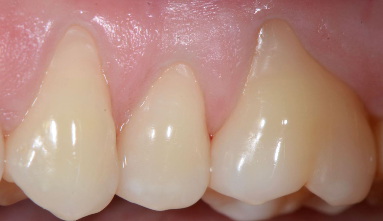 Recessione gengivale e terapia ortodontica: come comportarsi