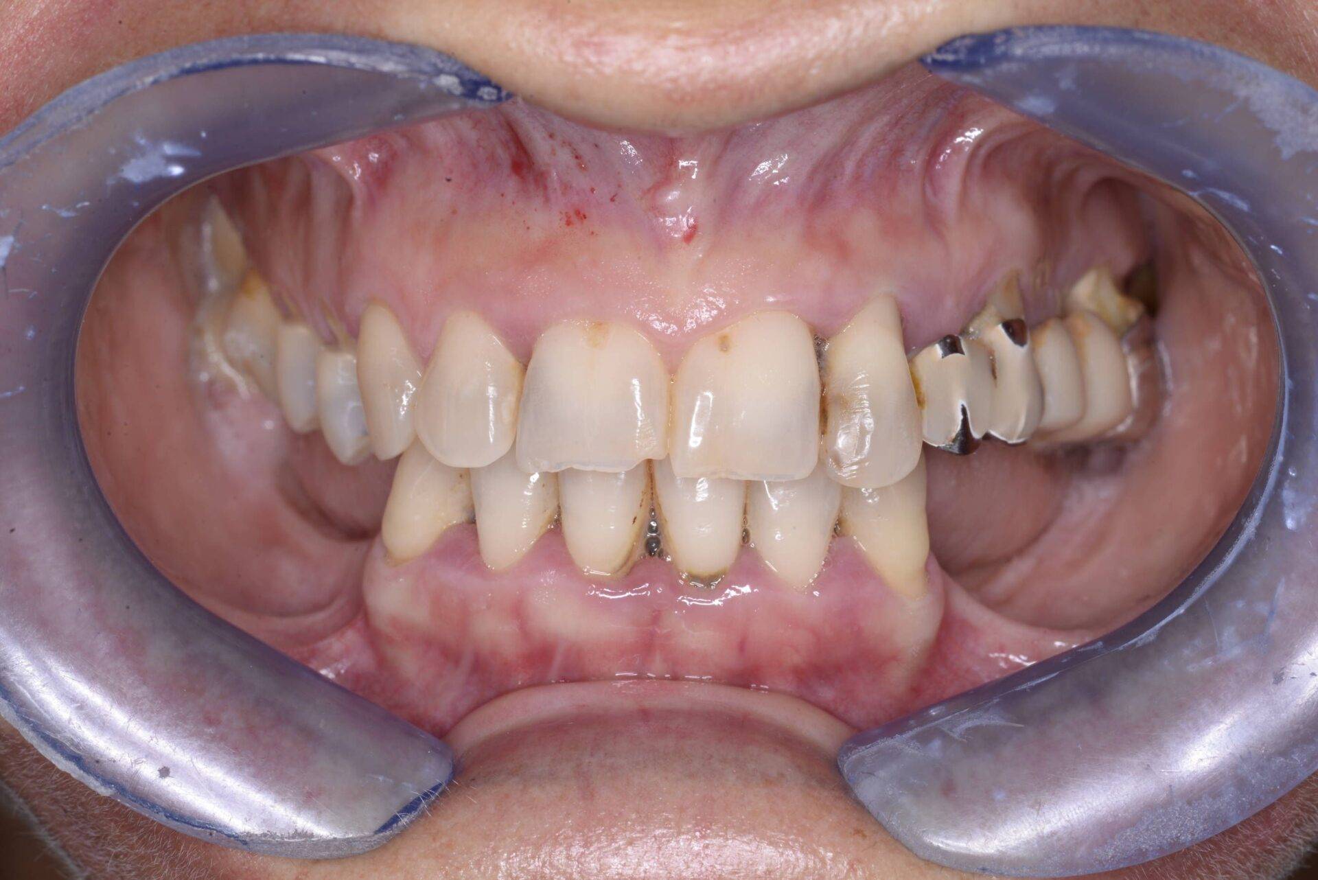 Parodontite necrotizzante: tutto ciò che devi sapere • Gengive.org