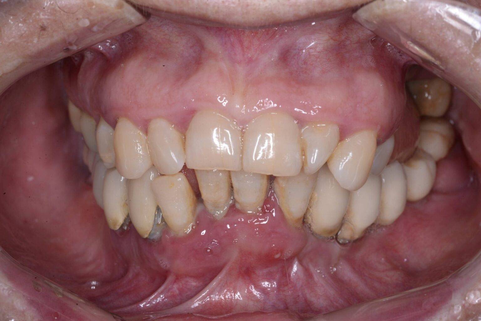 Gengive nere: perché succede e come comportarsi • Gengive.org