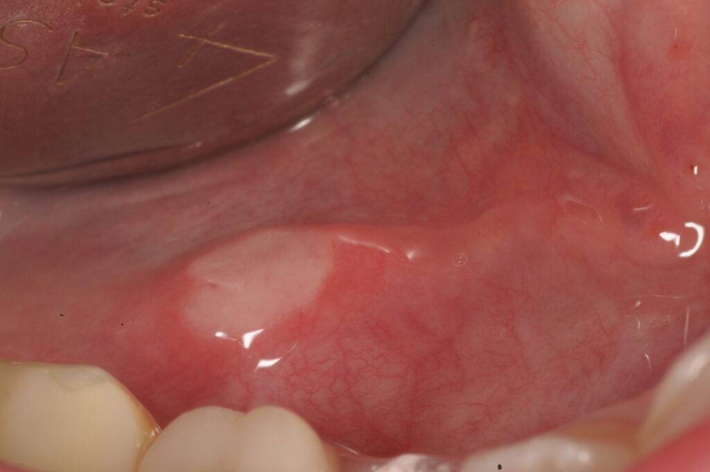 Afte orali: diagnosi, cause e trattamento • Gengive.org